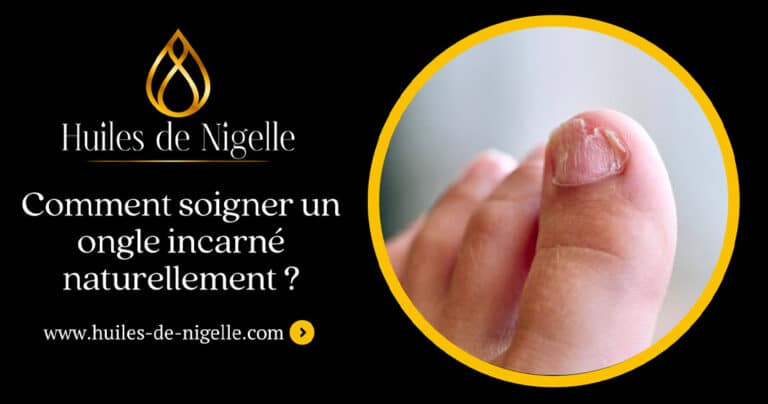 Soigner un ongle incarné naturellement | Le guide pratique en 2024
